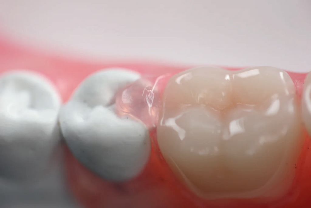 Flexible Partial Denture – PRODIRECT Dental Laboratory
