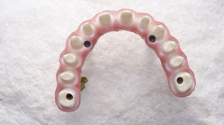 Toronto Bridge – PRODIRECT Dental Laboratory